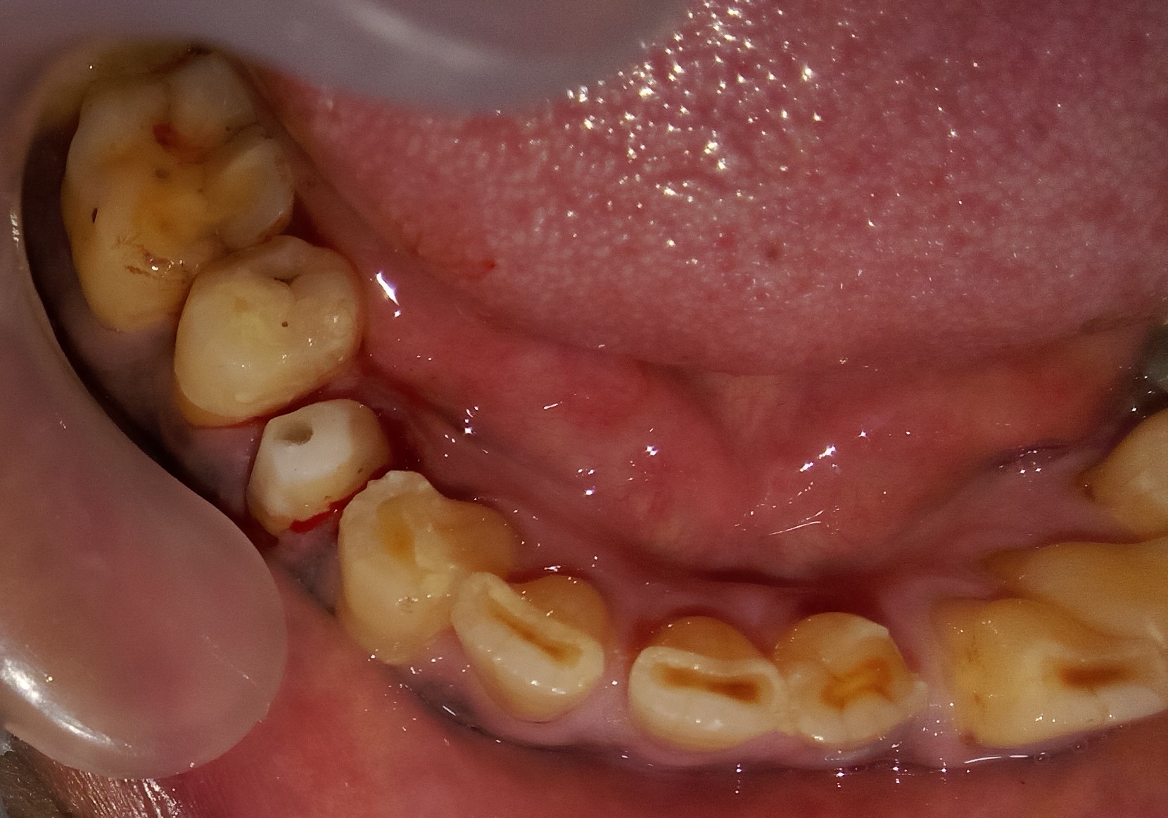 Replacing Missing Teeth: Dental Solutions for Fractured, Damaged, or ...