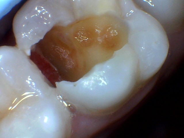 Understanding Root Canal Treatment: A Comprehensive Guide