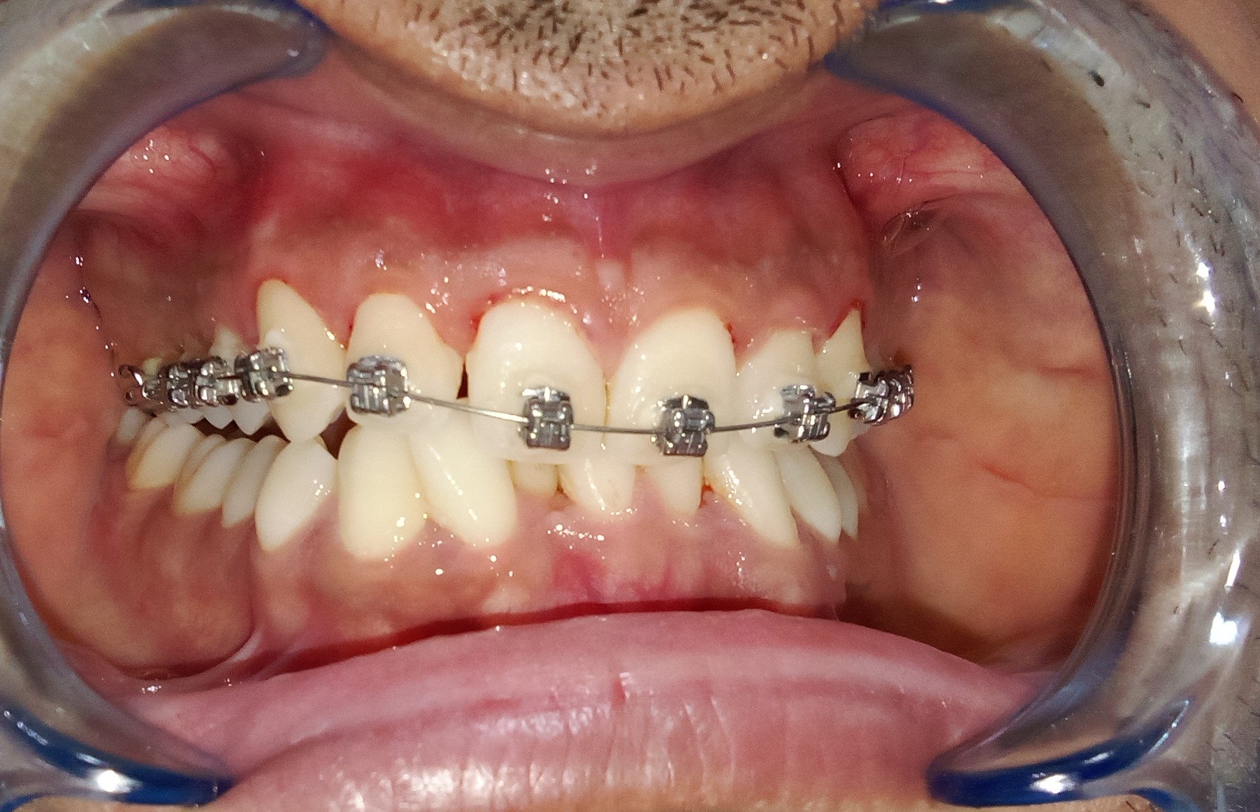 Closing the Gap: Dental Treatments for Crowding and Spacing of the Teeth
