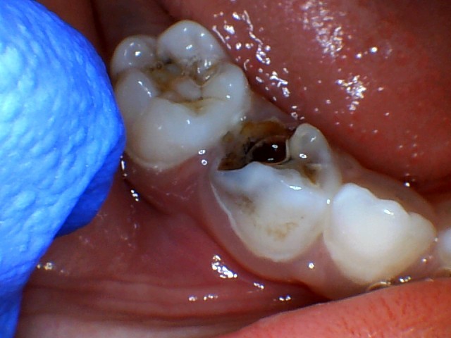 Understanding Pediatric Root Canal Treatment for Baby Teeth: What You ...