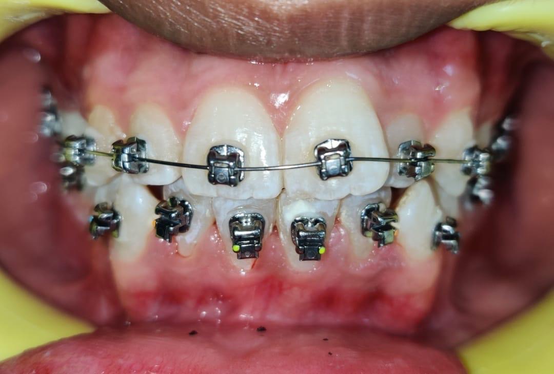 Comparing Self-Ligating Braces to Traditional Braces