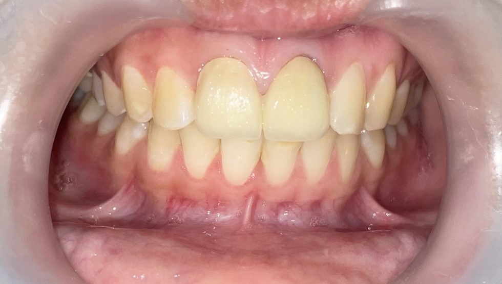 Understanding Dental Trauma: Types, Symptoms, and Treatment of Tooth ...