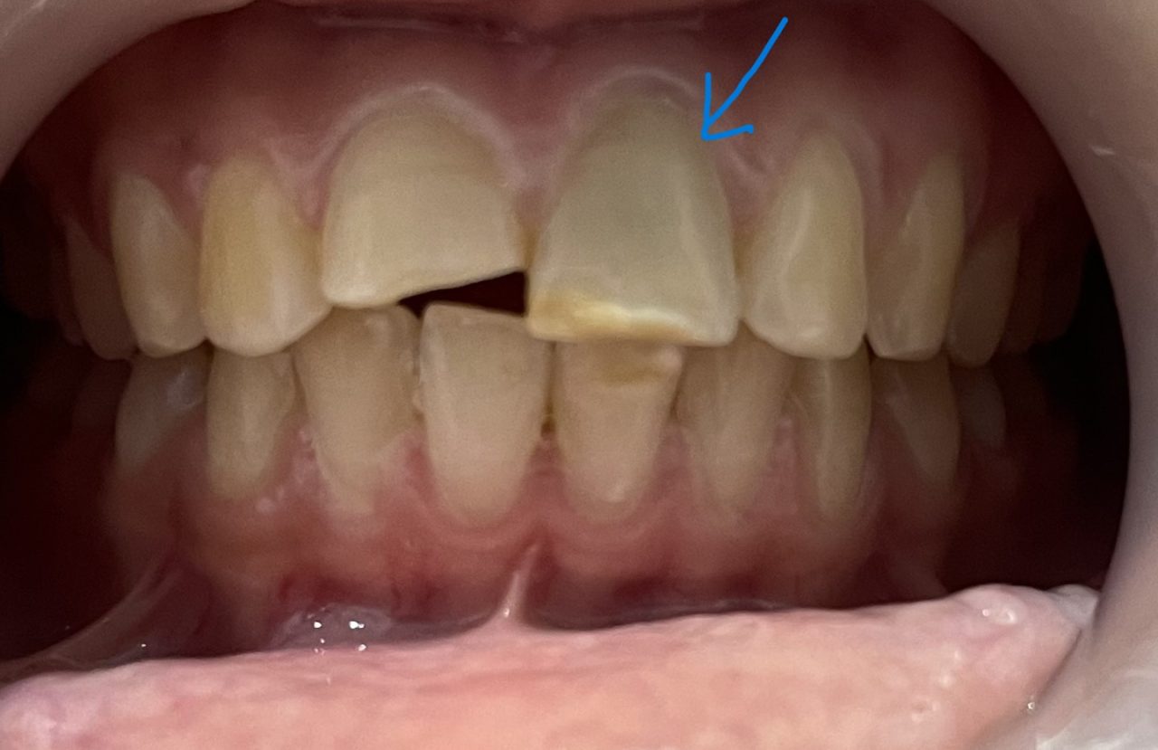Understanding Dental Trauma: Types, Symptoms, and Treatment of Tooth ...