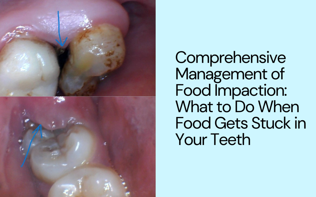 Cosequences of Food Lodgment for a long time between teeth - Tooth Wellness